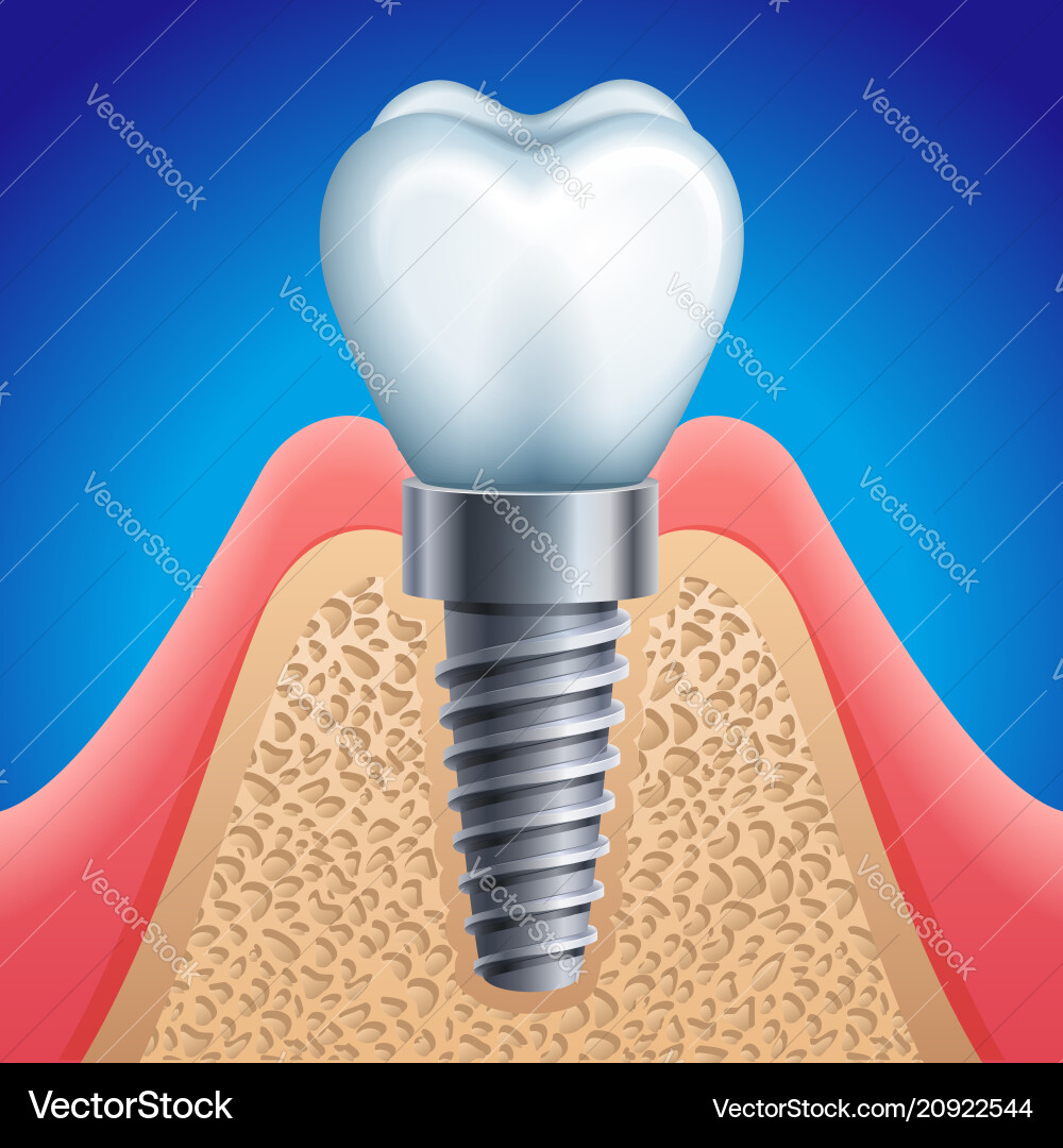 Dental implant icon Royalty Free Vector Image - VectorStock