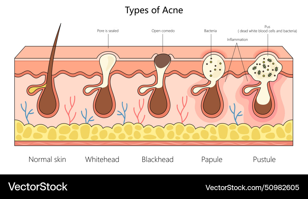 Different acne types diagram medical science Vector Image