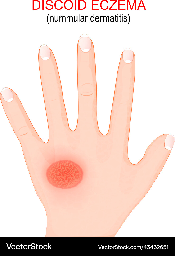 Nummular dermatitis discoid eczema Royalty Free Vector Image