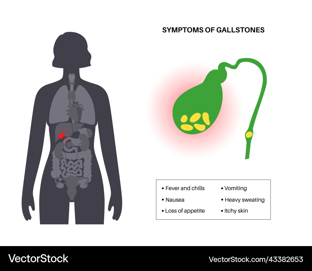 Gallstones Symptoms & Treatment Royalty Free Vector
