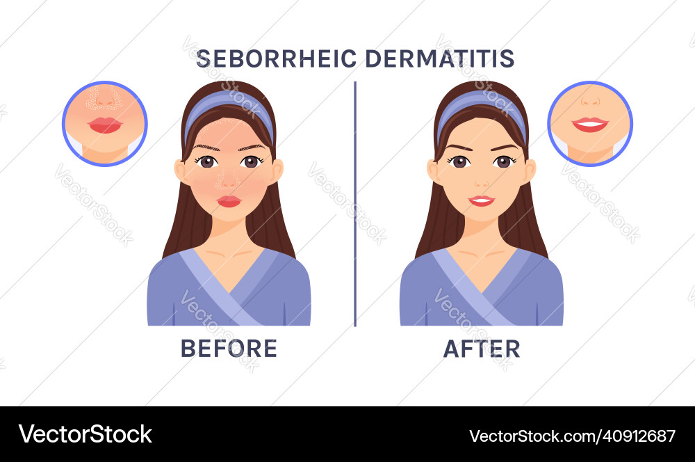 Seborrheic dermatitis on beautiful face skin Vector Image