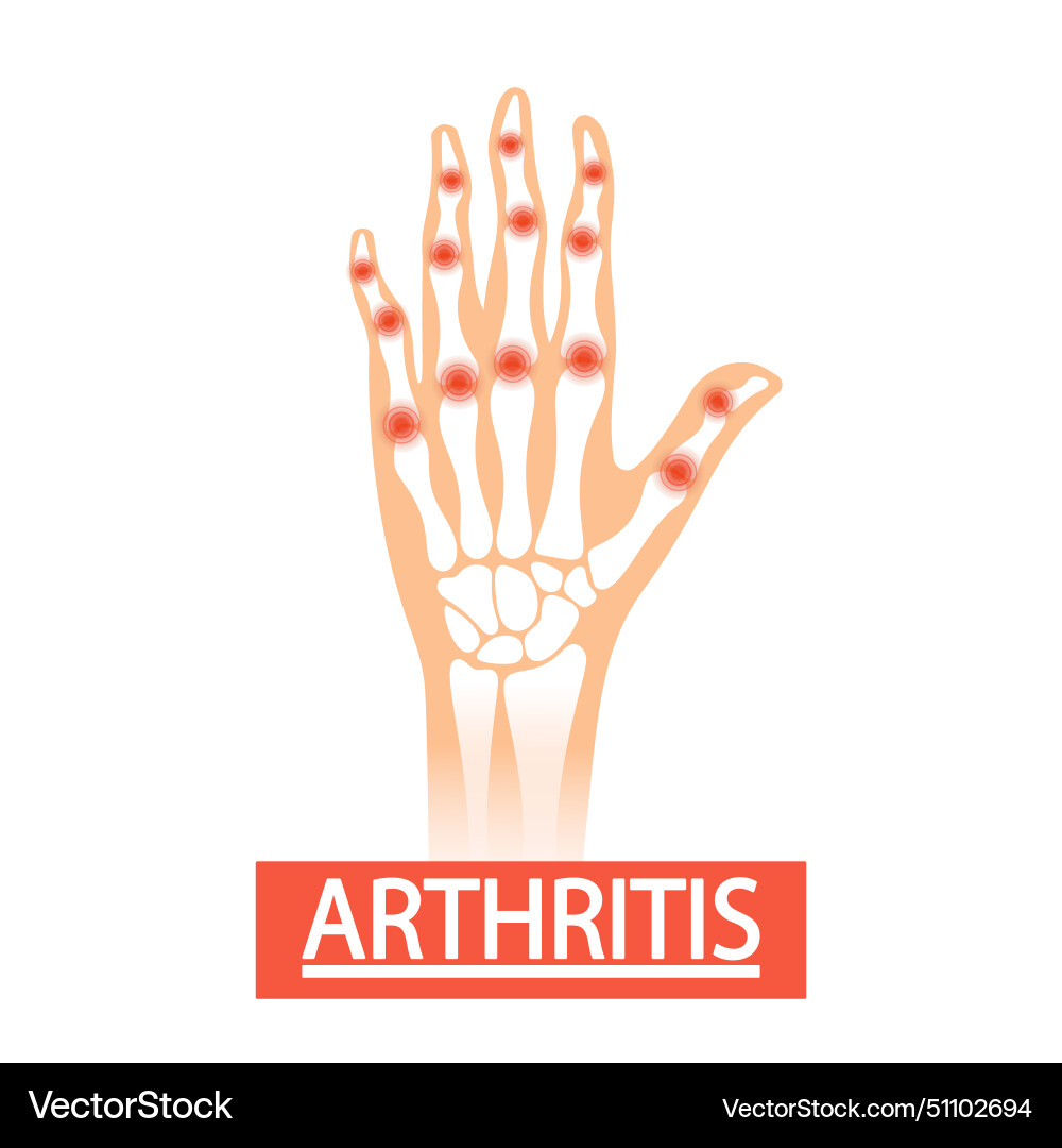 Human hand with arthritis medical Royalty Free Vector Image