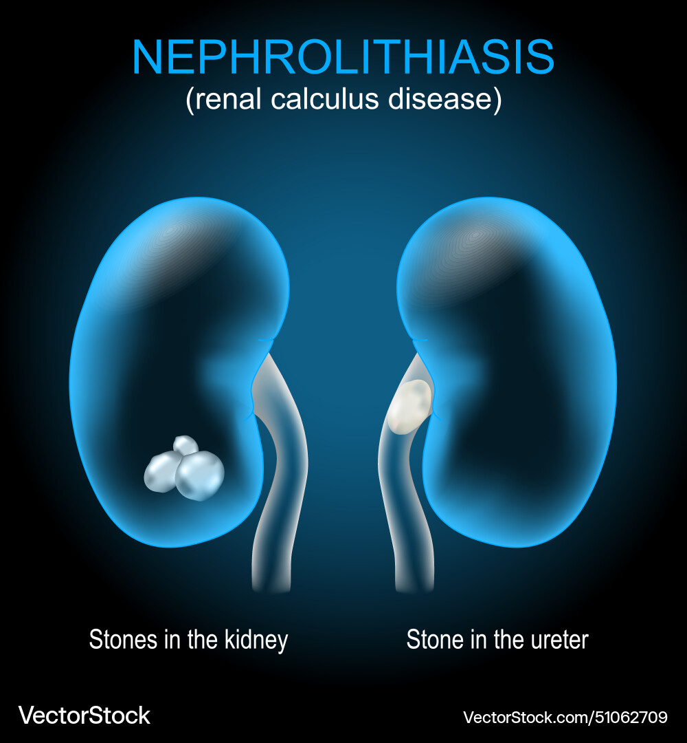 Kidney stone disease renal calculus Royalty Free Vector