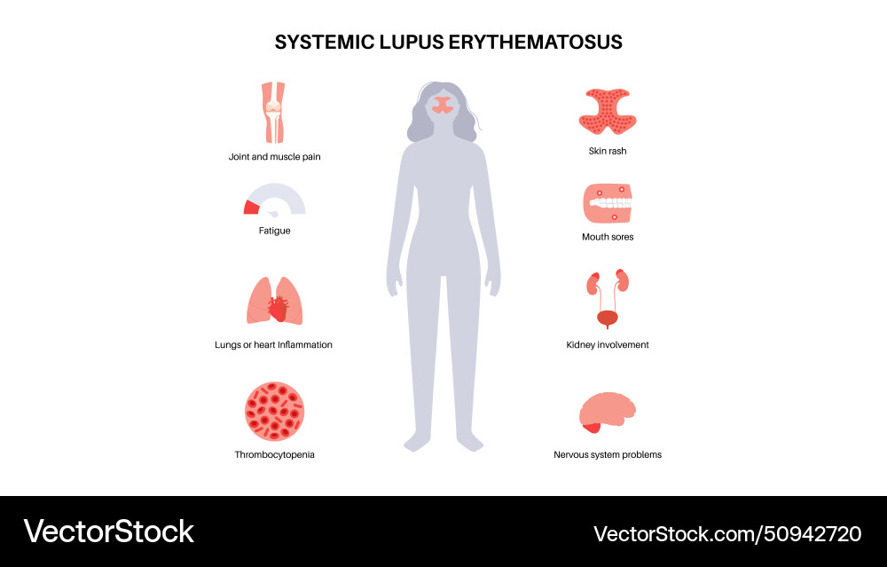 Systemic lupus erythematosus Royalty Free Vector Image