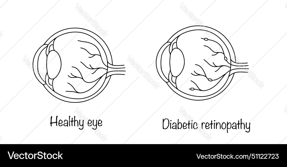 Diabetic retinopathy Royalty Free Vector Image