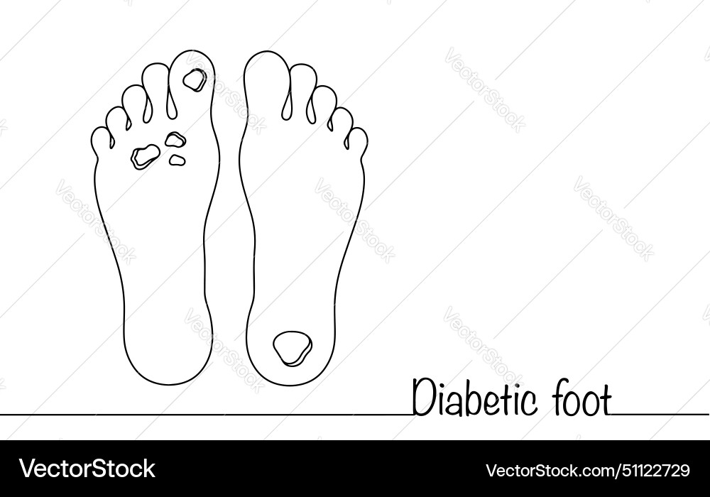 Diabetic foot Royalty Free Vector Image - VectorStock