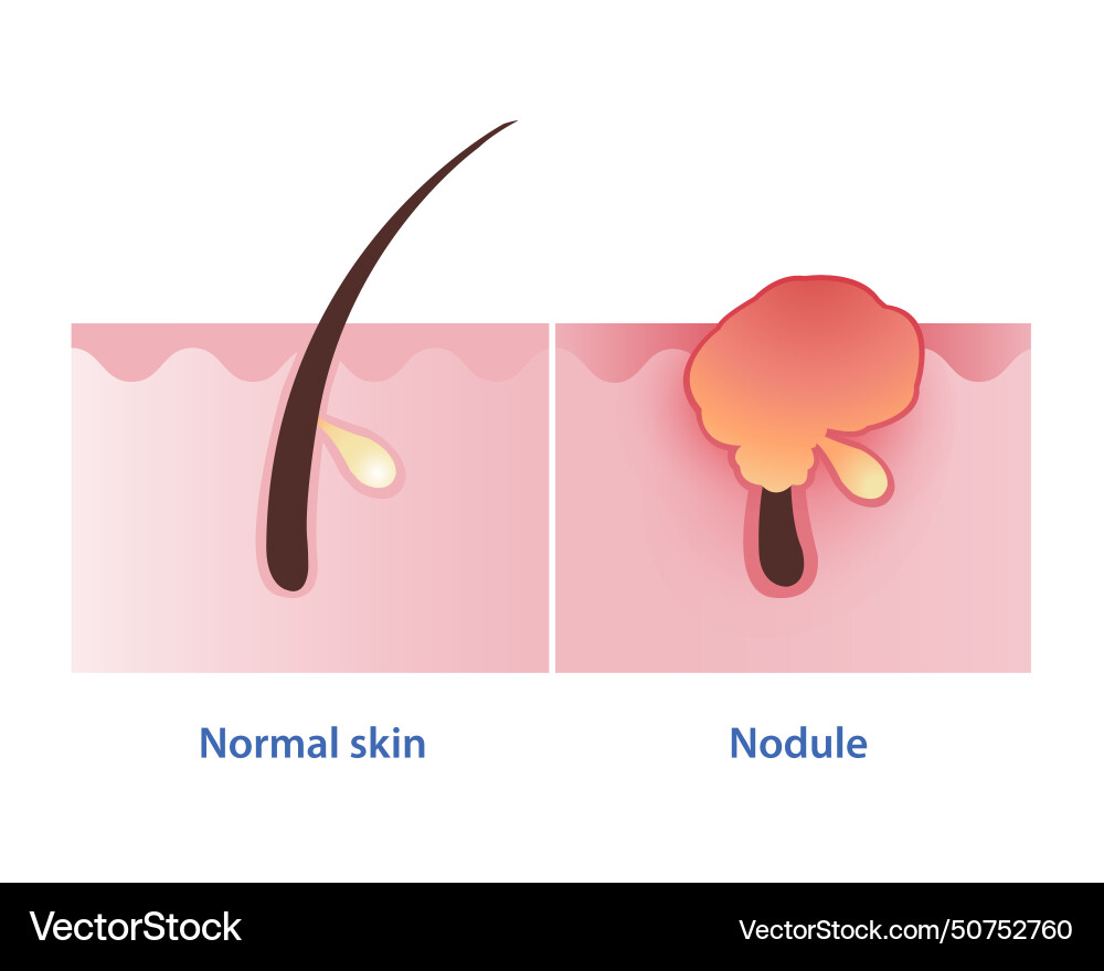 Nodule type of inflammatory acne Royalty Free Vector Image