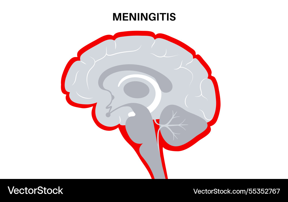 Meningitis medical poster Royalty Free Vector Image