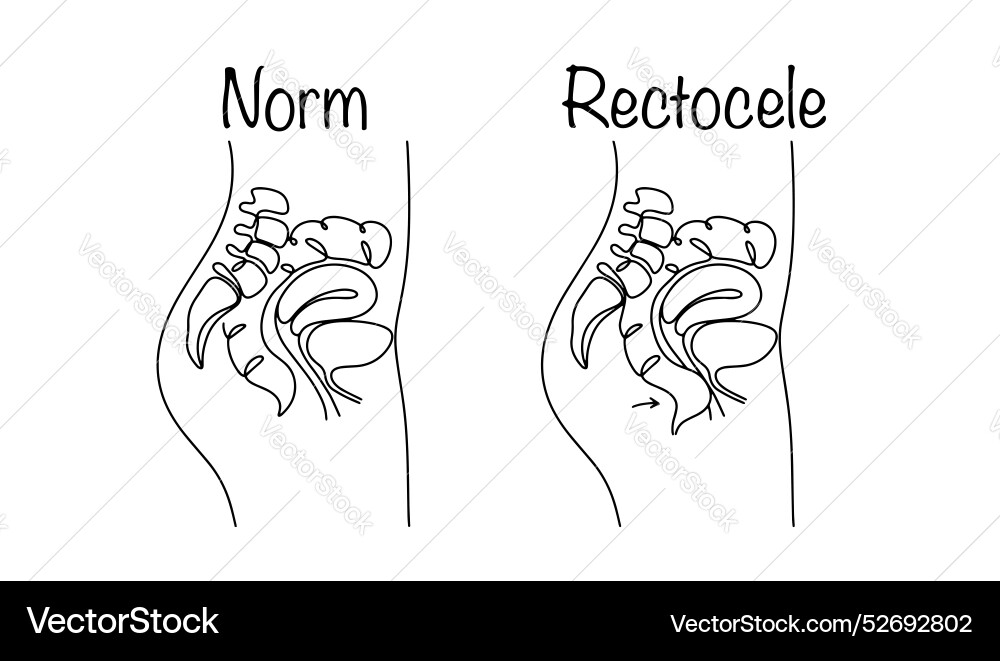 Rectocele Royalty Free Vector Image - VectorStock