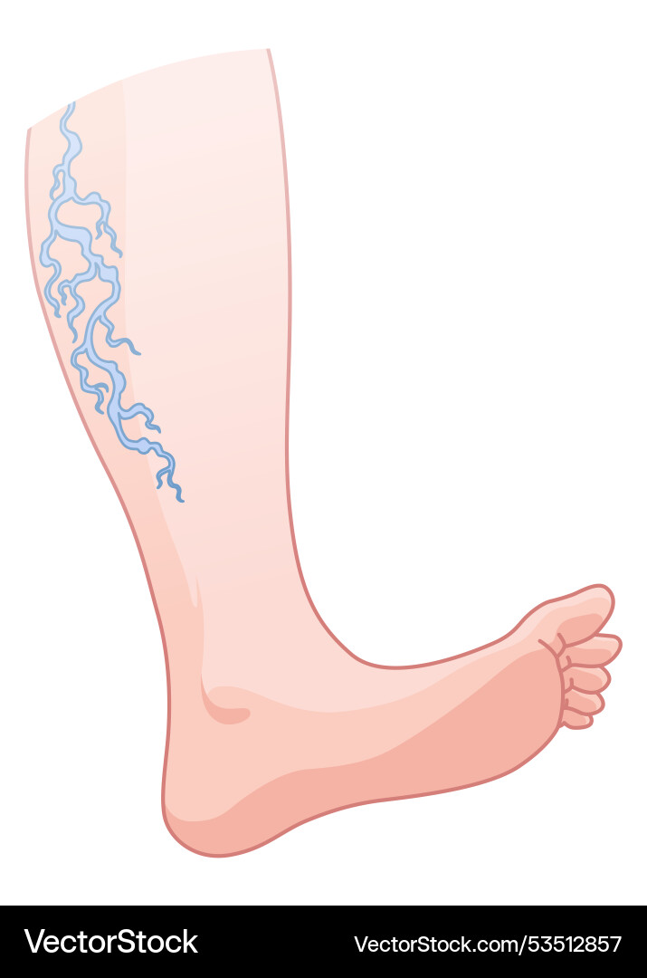 Varicose veins blue blood vessel visible through Vector Image