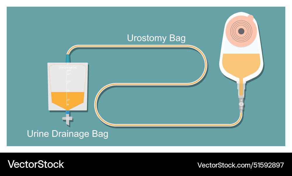 Urostomy bag and urine drainage Royalty Free Vector Image