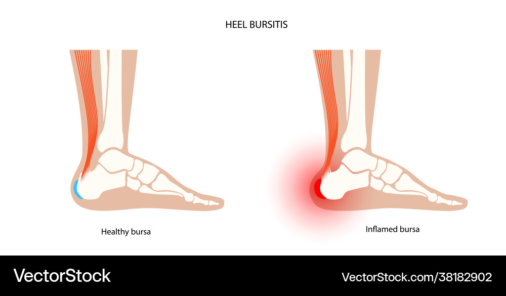 Heel Bursitis - Inflammation Concept Royalty Free Vector