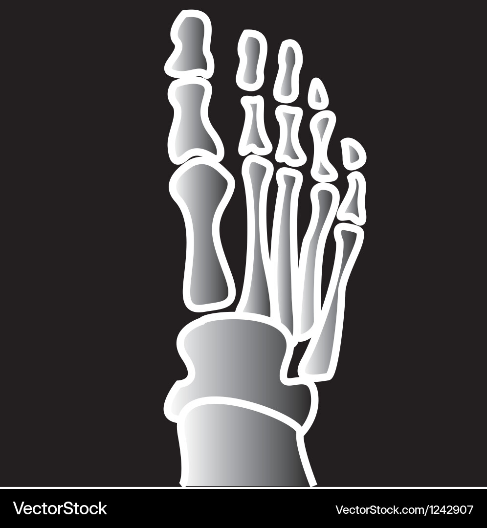 X-Ray Fractured Bones Royalty Free Vector Image