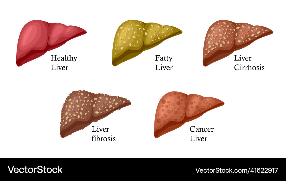 Stages of liver damage disease Royalty Free Vector Image