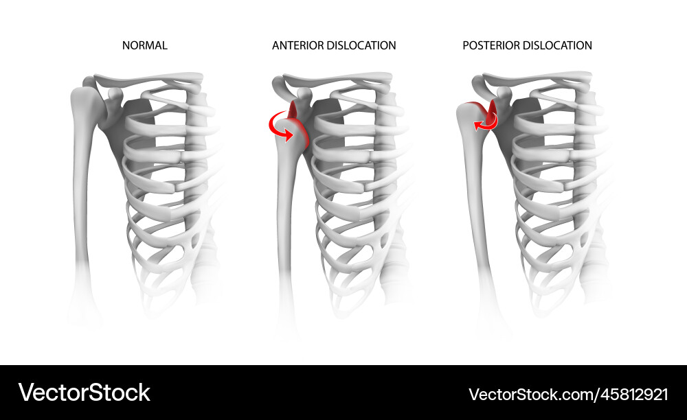 Tendinitis Vector Images (over 130)