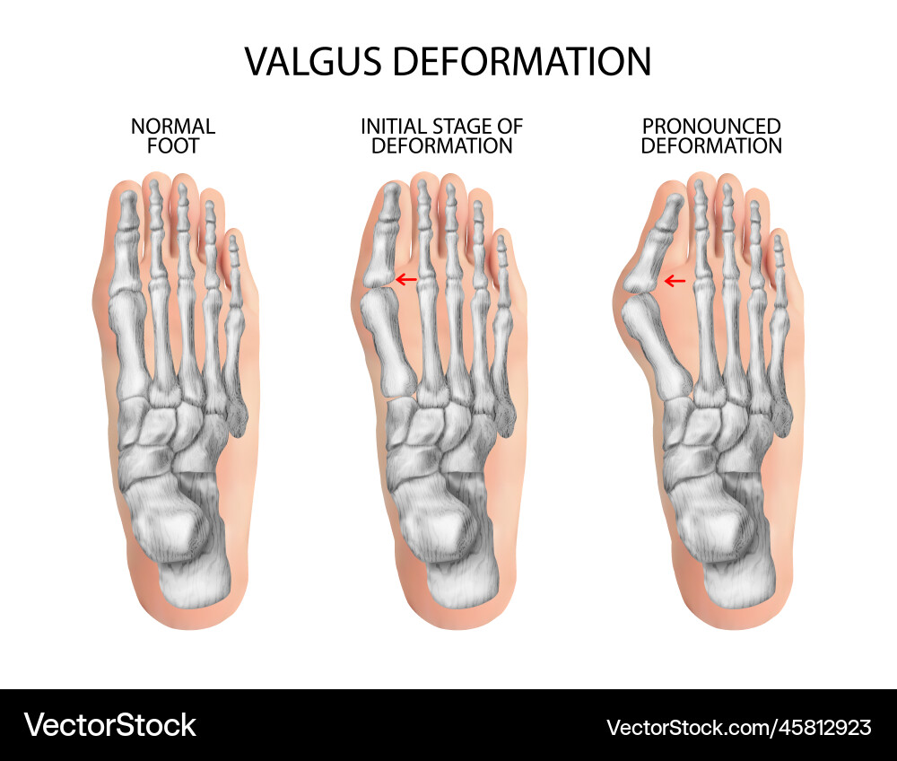 Valgus deformity of the toes Royalty Free Vector Image