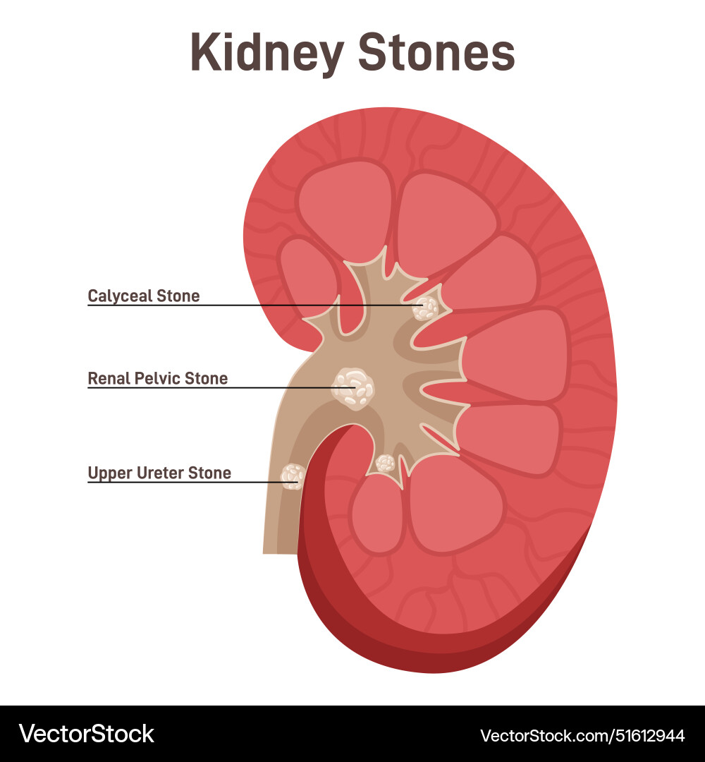 Nephrolithiasis kidney stones disease nephrology Vector Image
