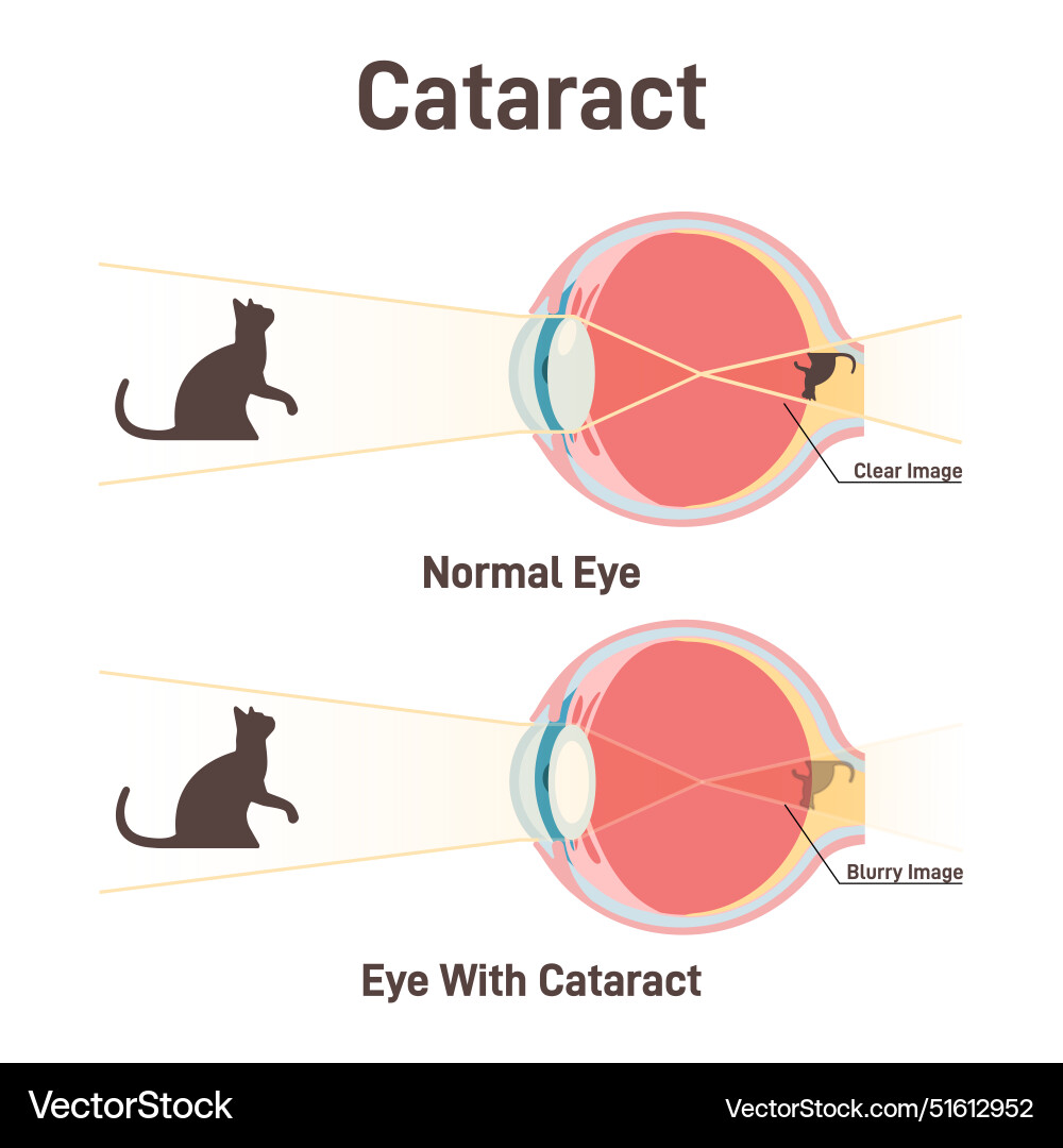 Cataract clouding of the lens decrease vision Vector Image