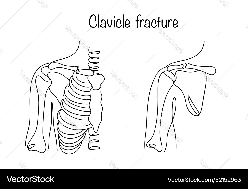 Clavicle fracture Royalty Free Vector Image - VectorStock