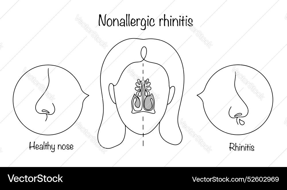Nonallergic rhinitis Royalty Free Vector Image