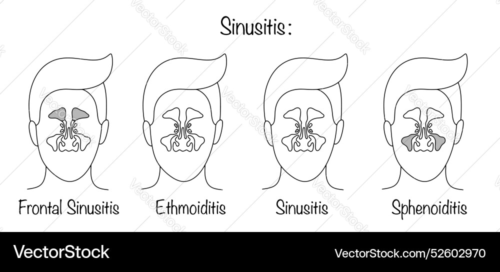 Types of sinusitis Royalty Free Vector Image - VectorStock