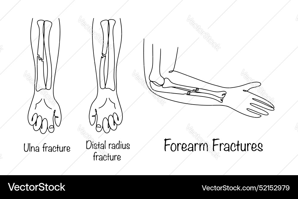 Fracture of forearm bones Royalty Free Vector Image
