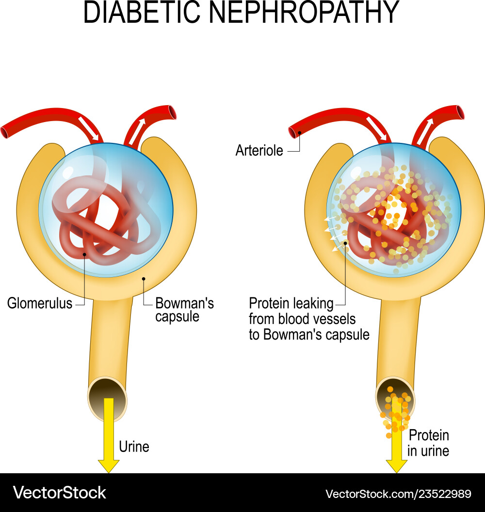 Diabetic nephropathy kidney disease Royalty Free Vector