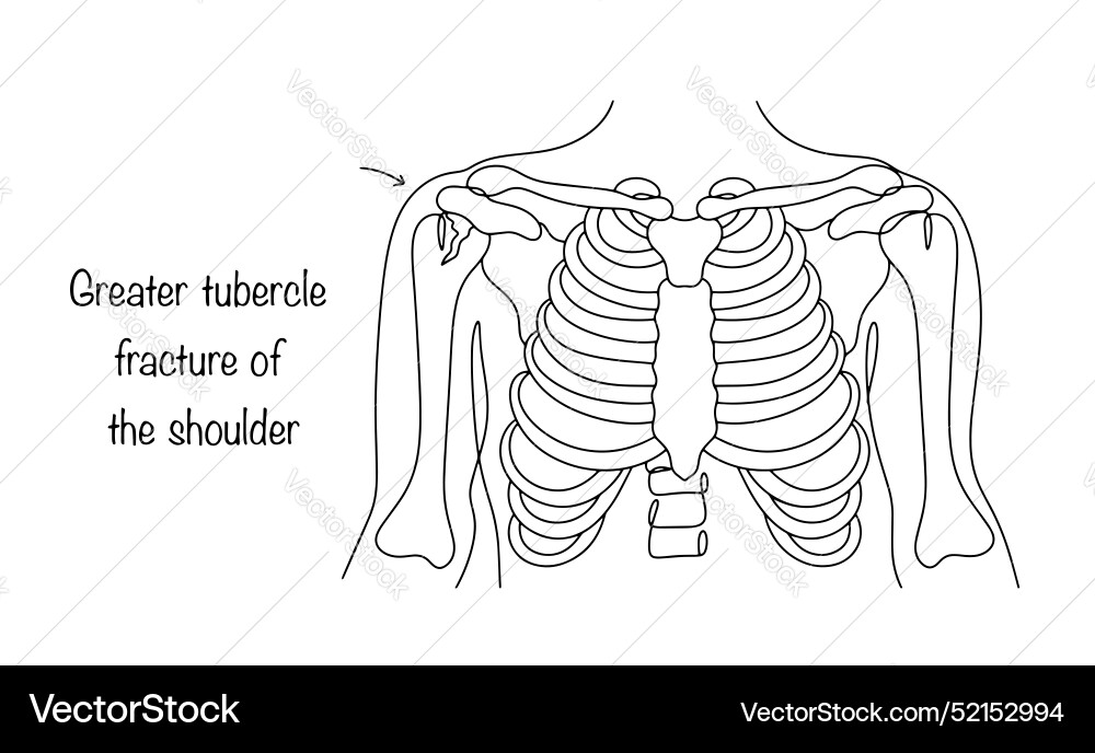 Shoulder fracture Royalty Free Vector Image - VectorStock