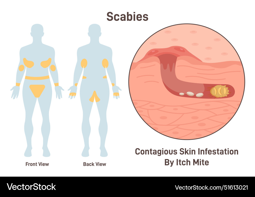 Scabies skin infestation with itch mite infected Vector Image