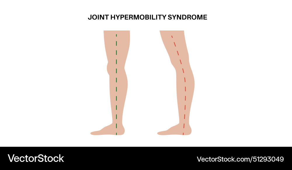 Joint hypermobility poster Royalty Free Vector Image