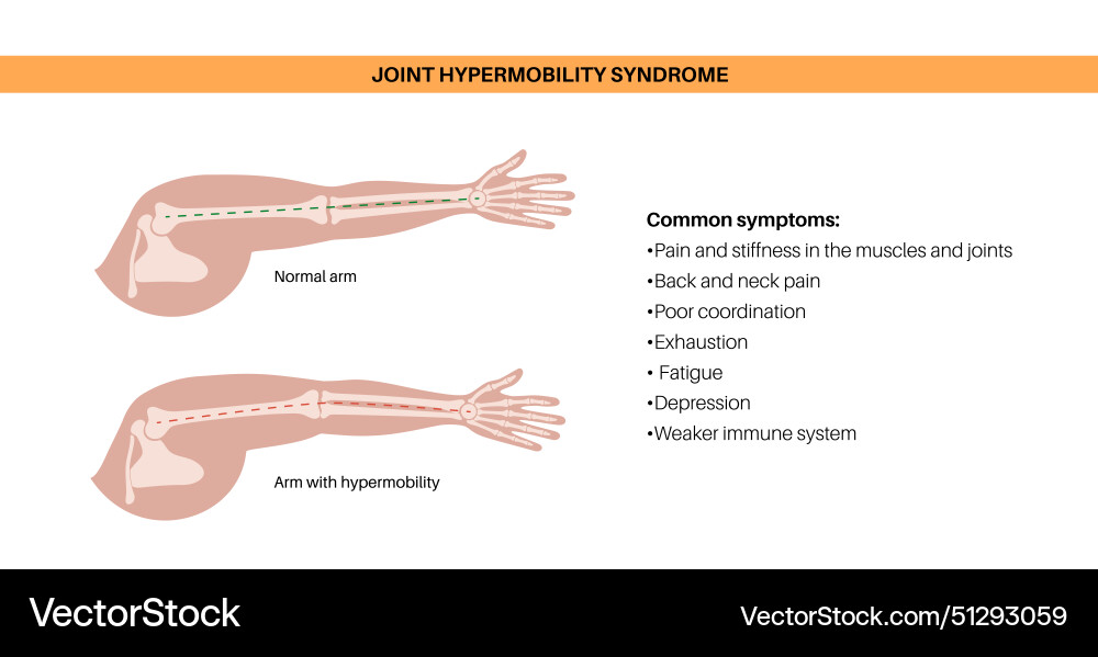 Joint hypermobility poster Royalty Free Vector Image