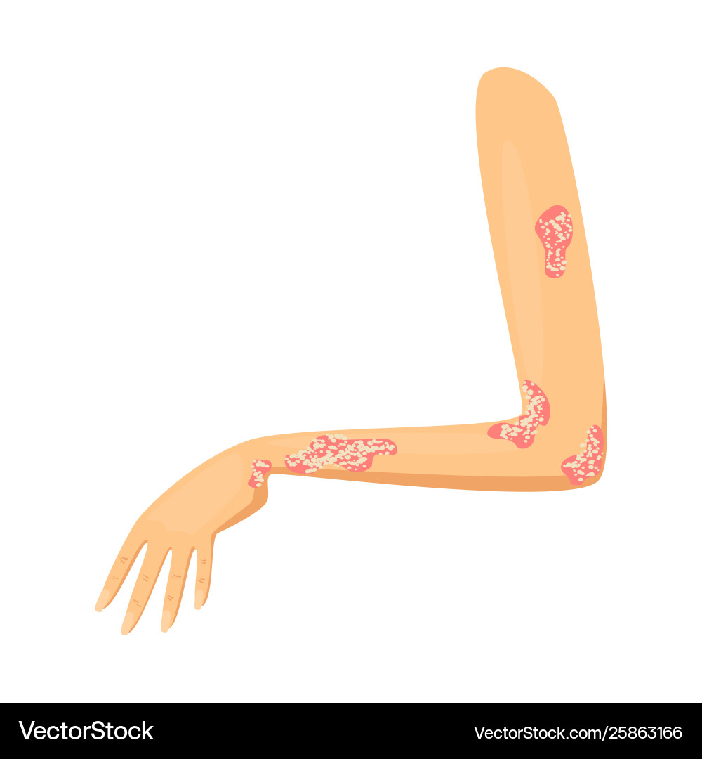 Psoriasis and dermatitis Royalty Free Vector Image