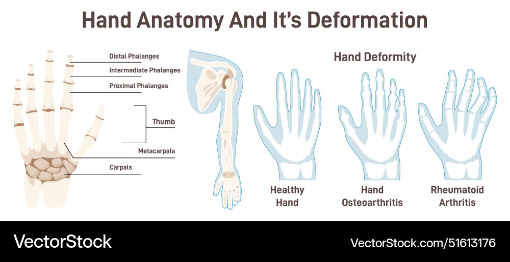 menschliche Handknochen und ihre Verformungen anatomisch
