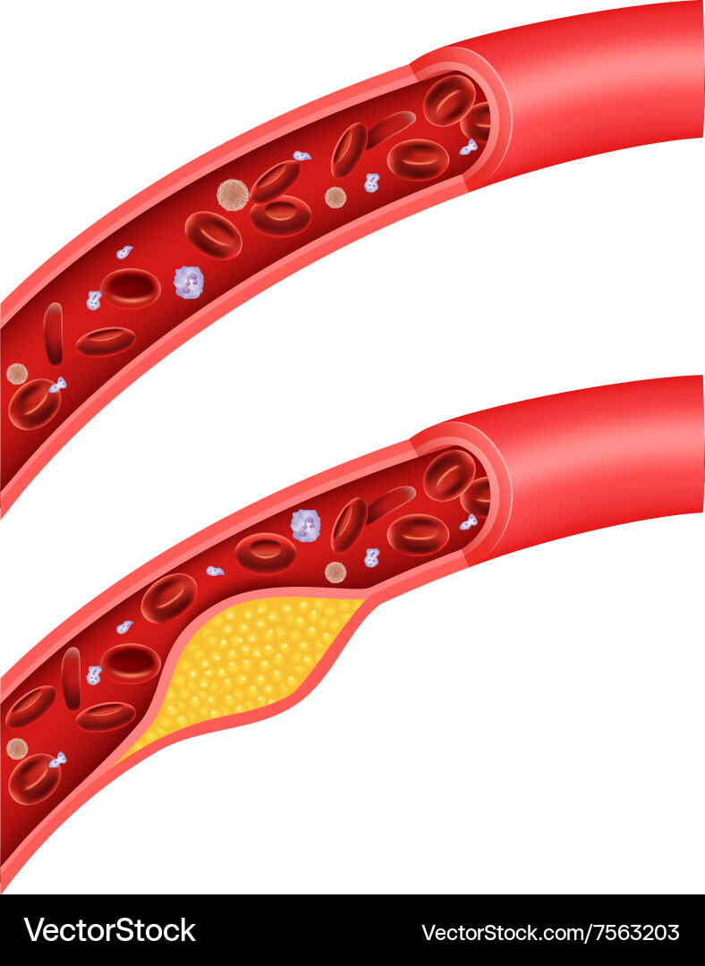 High Cholesterol Cartoon Get Back In The Game Keep On Top Of