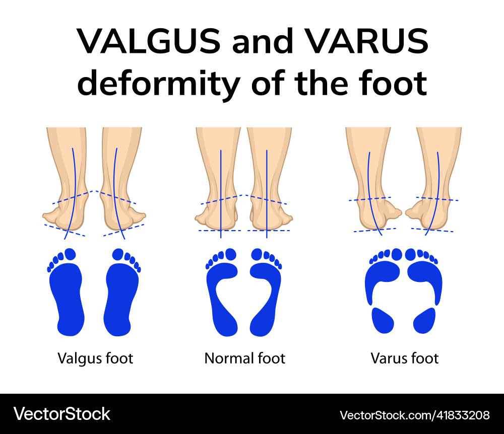 Varus Vs Valgus Valgus Knee Hi Res Stock Photography And Images