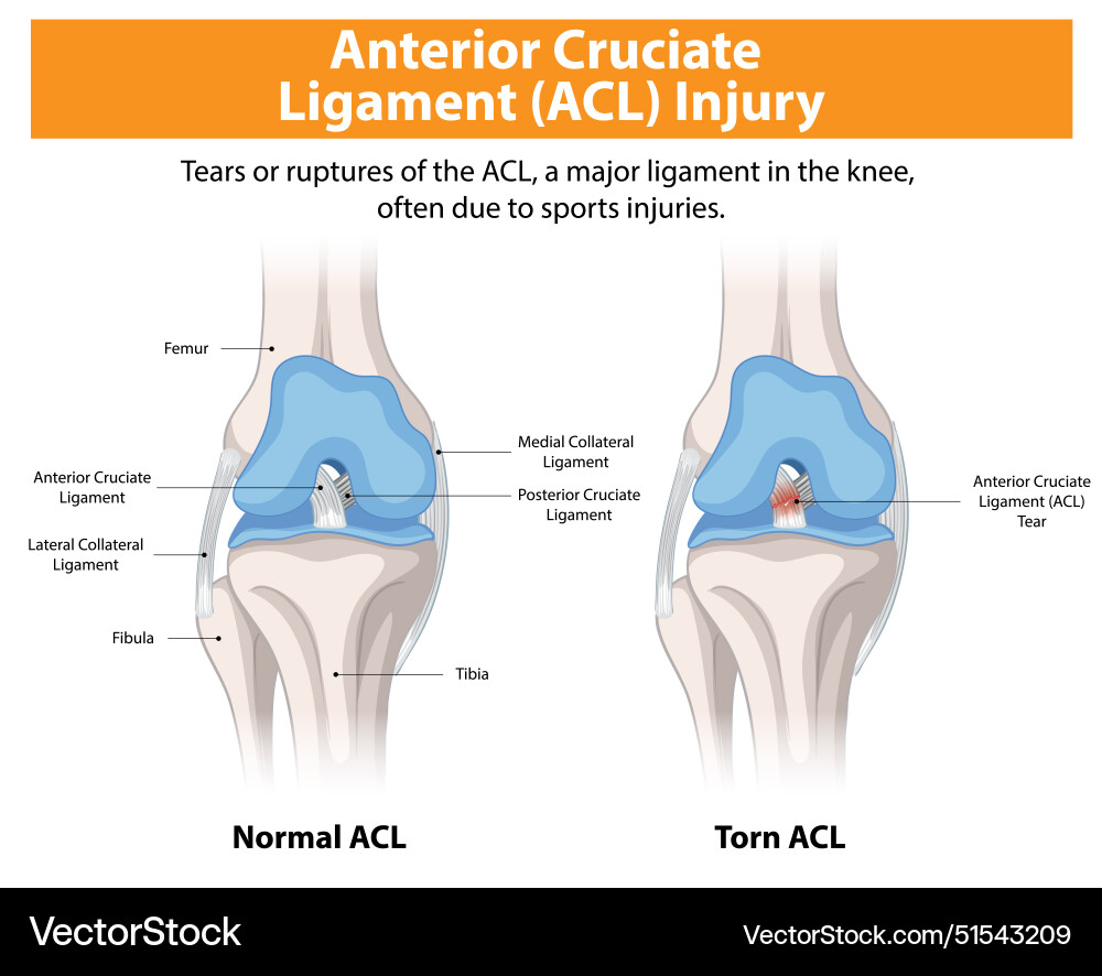 Comparison of normal and torn acl in the knee Vector Image
