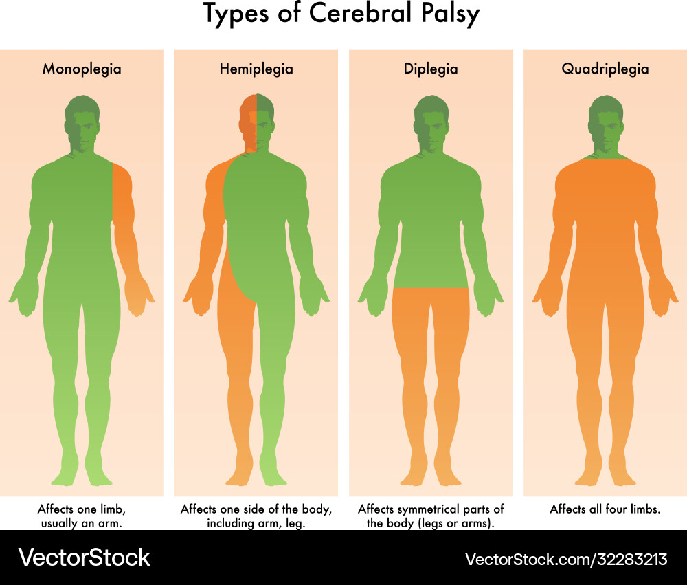 Paralysis Cerebral Vector Images (61)