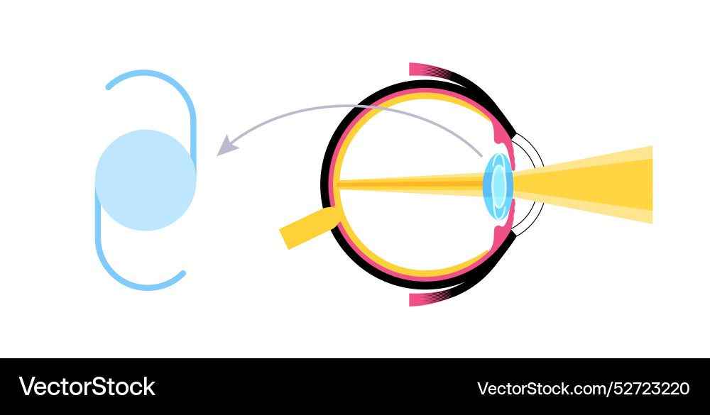 Intraocular lens poster Royalty Free Vector Image
