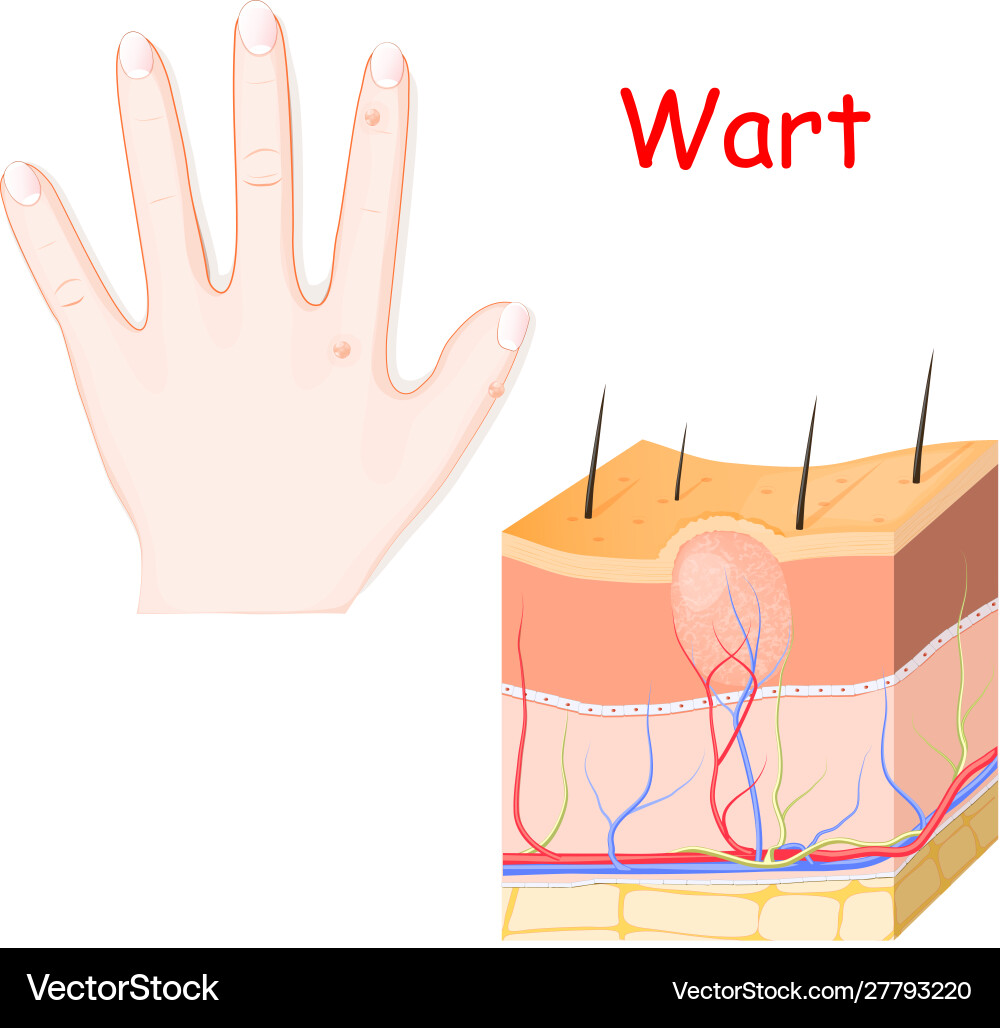 Warts on a hand cross section detailed wart Vector Image