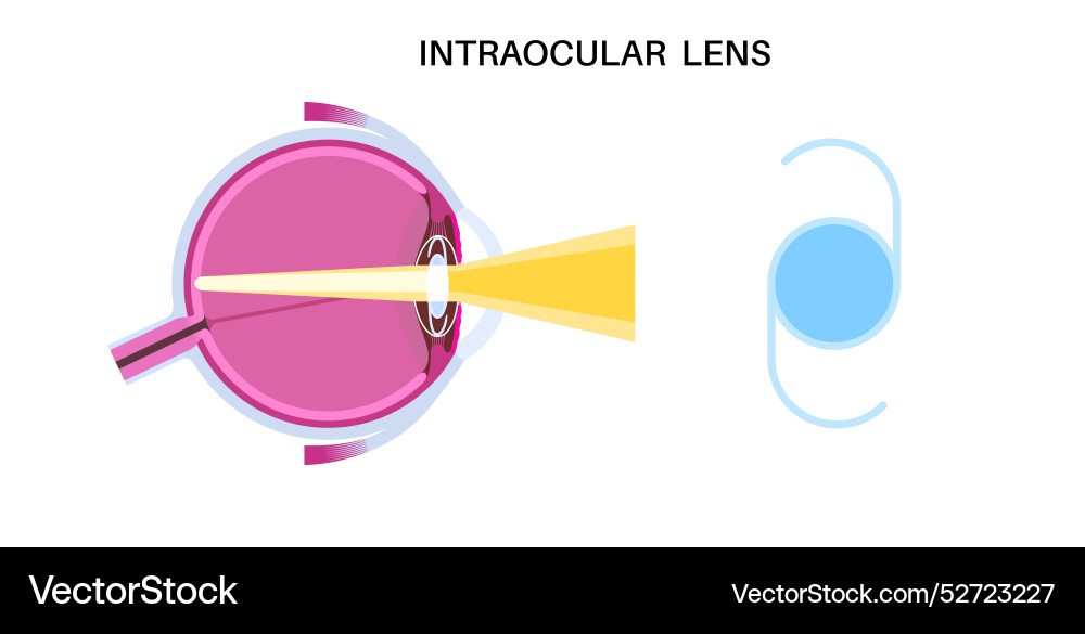 Intraocular lens poster Royalty Free Vector Image
