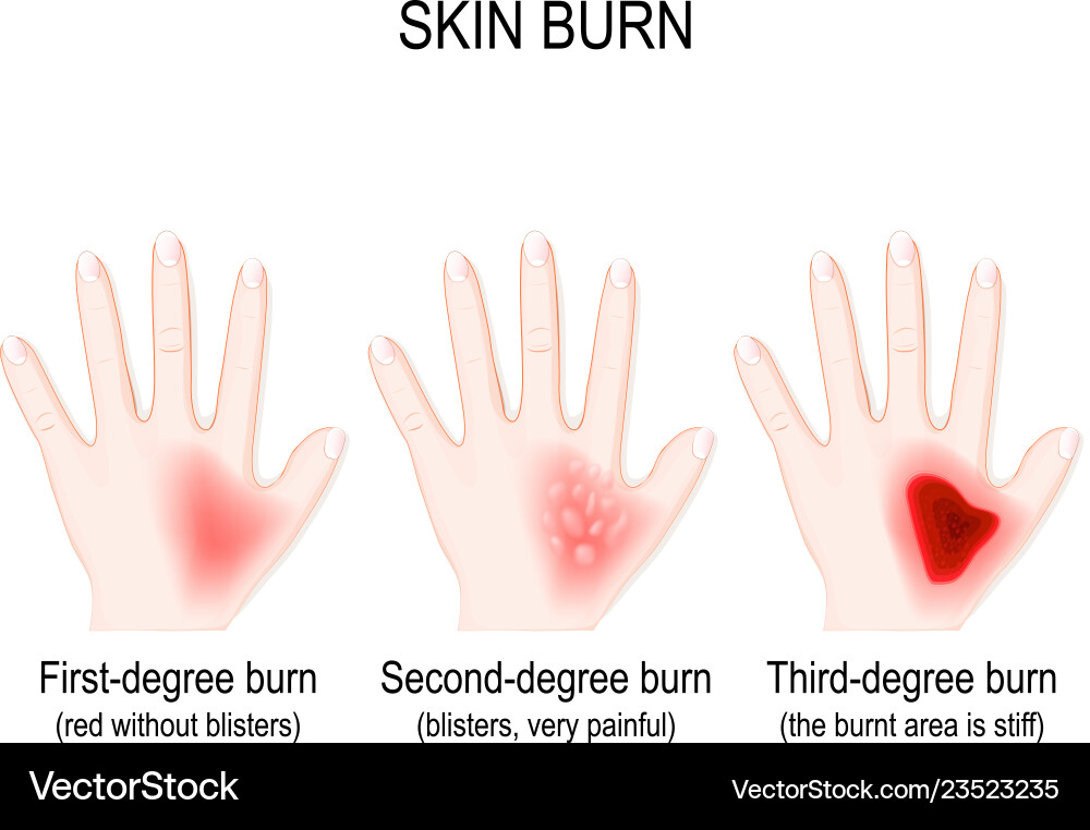 Degree burns of skin step burn Royalty Free Vector Image
