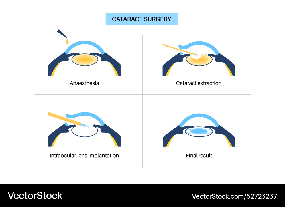Cataract surgery poster Royalty Free Vector Image