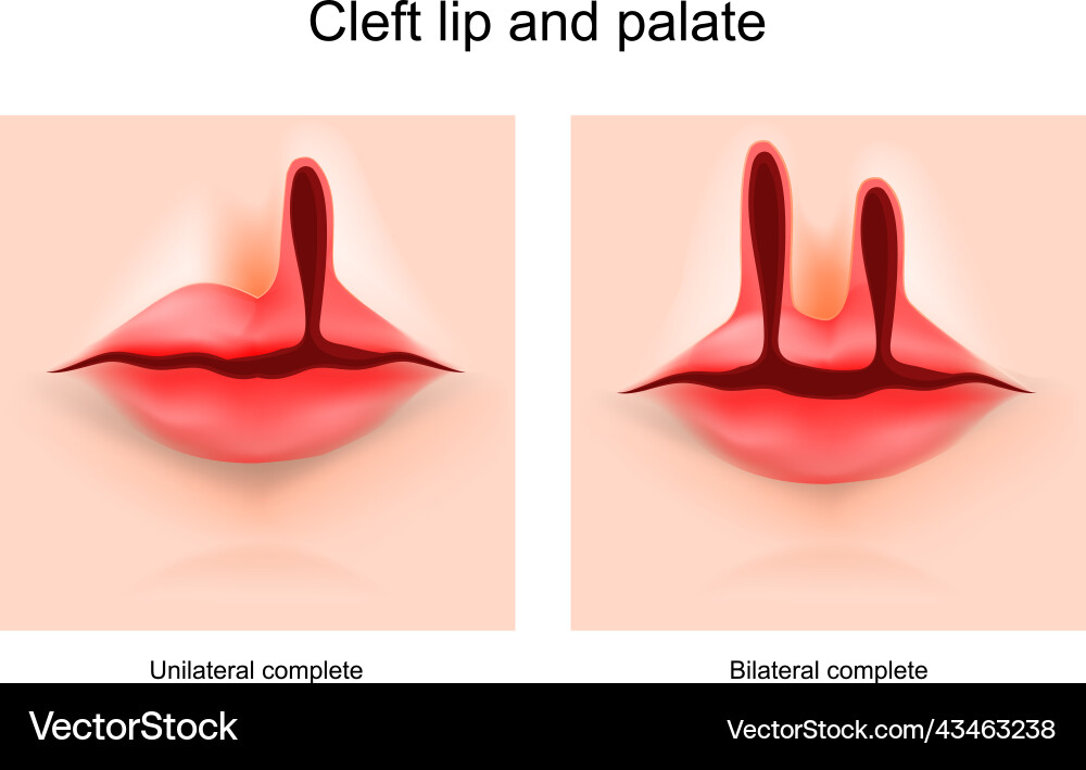 Cleft lip and palate Royalty Free Vector Image