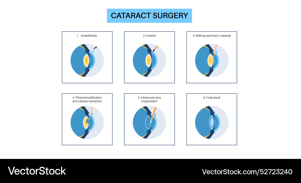 Cataract surgery poster Royalty Free Vector Image