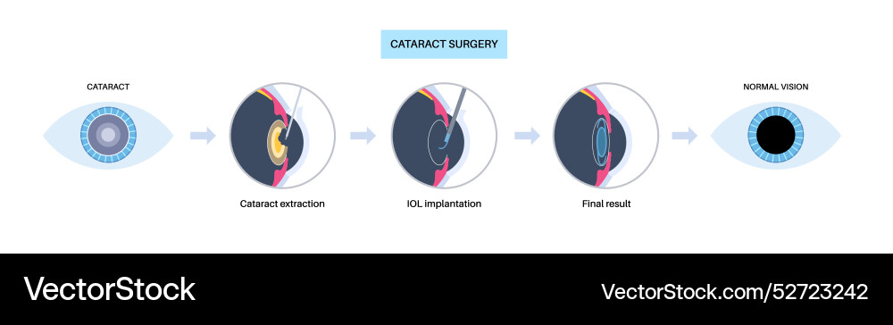 Cataract surgery poster Royalty Free Vector Image