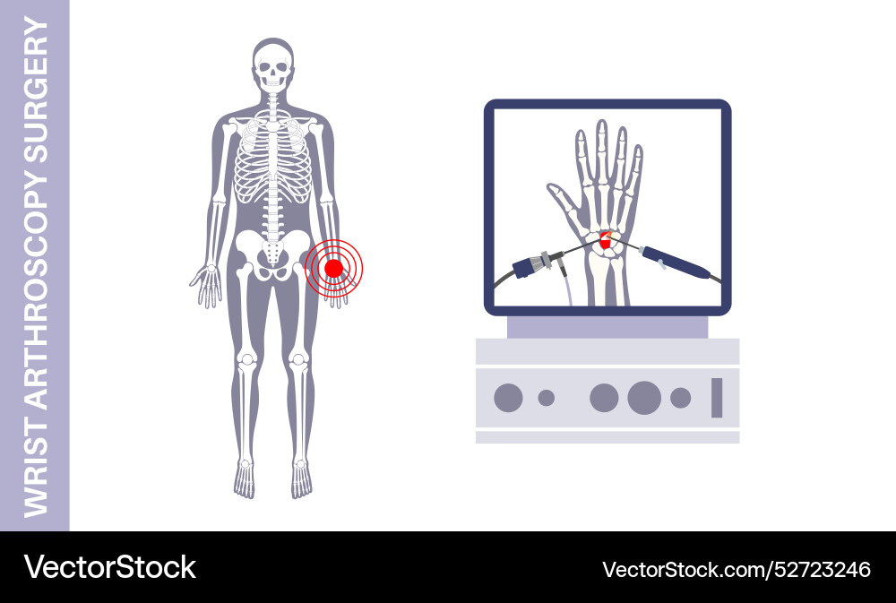 Wrist arthroscopy surgery Royalty Free Vector Image