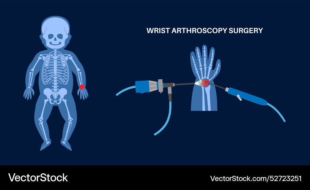 Wrist arthroscopy surgery Royalty Free Vector Image