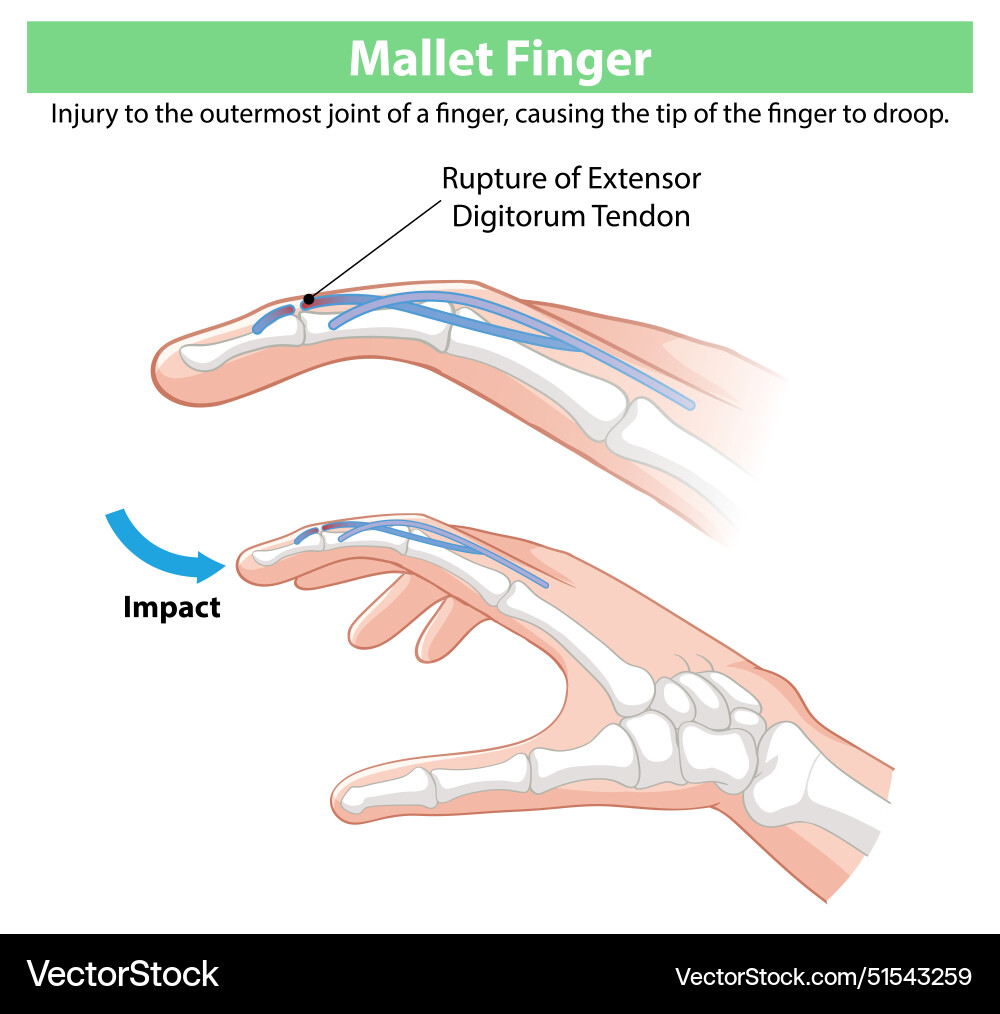 Depicts rupture of extensor digitorum tendon Vector Image