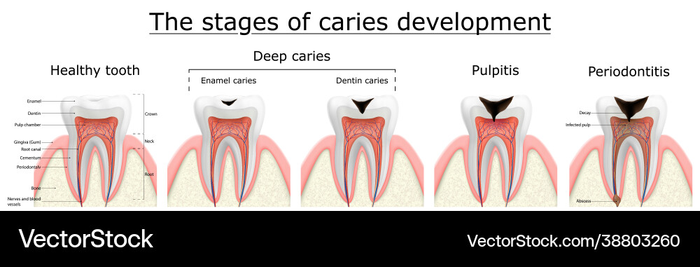 Stages caries development dental disease Vector Image
