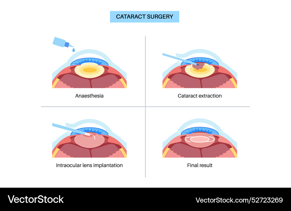 Cataract surgery poster Royalty Free Vector Image